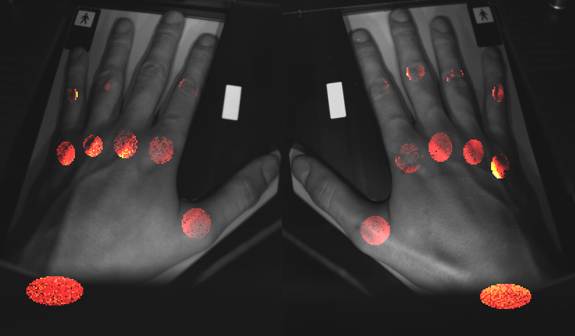 fast, painless and objective screening for rheumatoid arthritis.